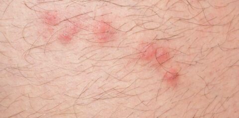 Wie sehen Flohbisse aus? Erkennen Behandeln Loswerden